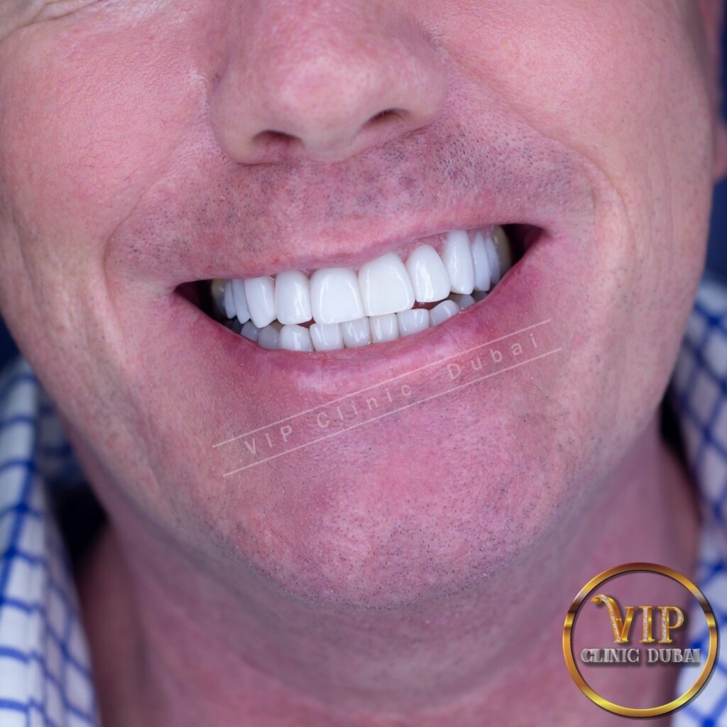 Vip Clinic Veneers Dubai - VIP Clinic Dubai
