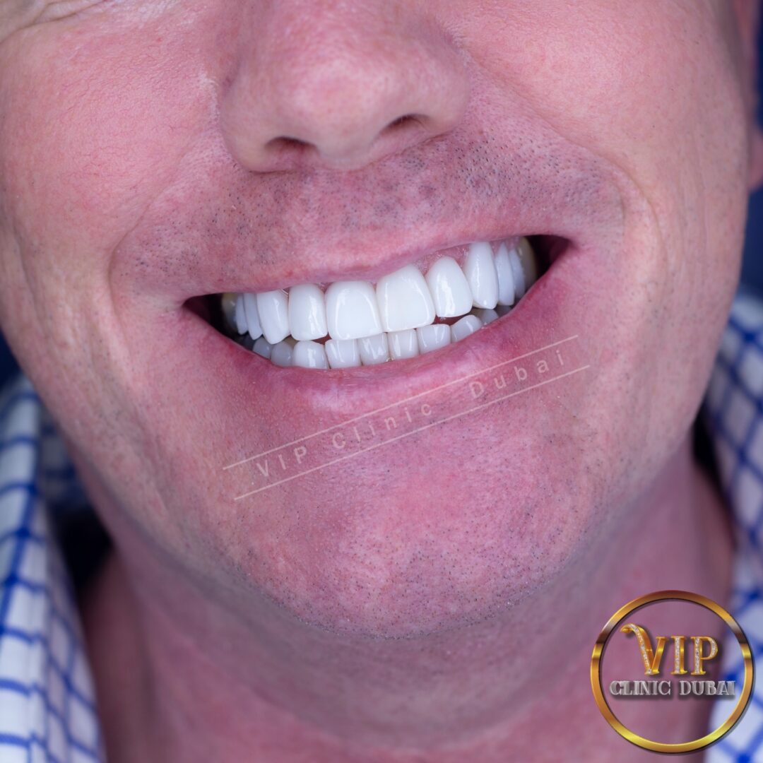 Vip Clinic Veneers Dubai - VIP Clinic Dubai