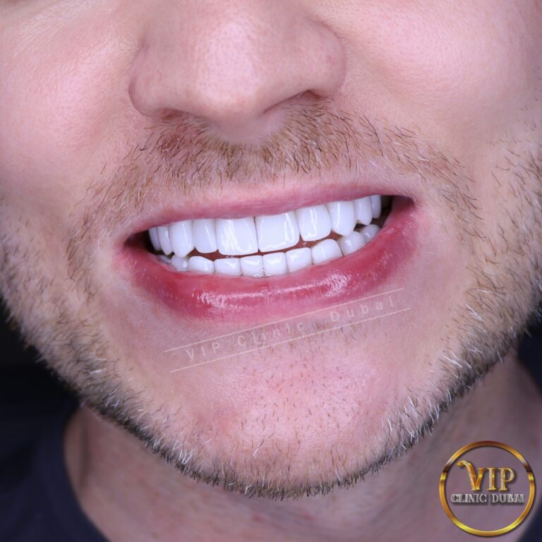 Vip Clinic Veneers Dubai - VIP Clinic Dubai