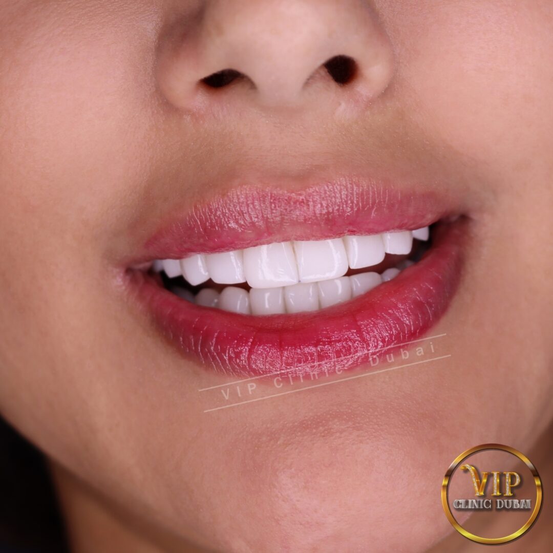 Vip Clinic Veneers Dubai - VIP Clinic Dubai